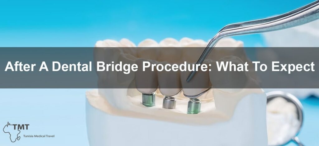 Dental bridges: Procedure, care & experts