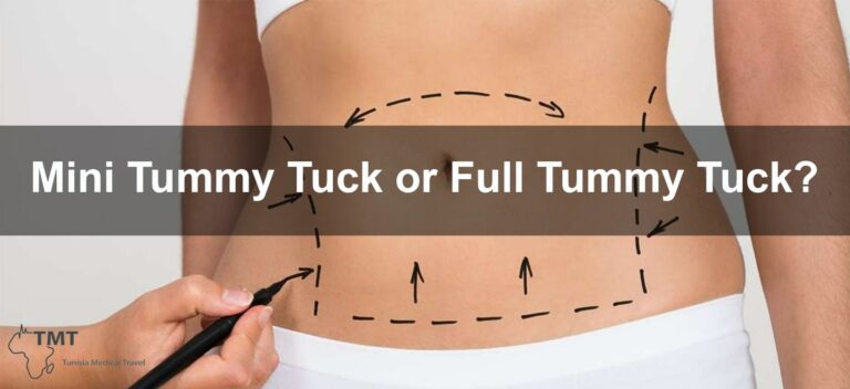 Tummy tuck surgery : Full vs. mini for your best look