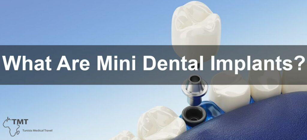 Mini dental implants: Stable, comfortable, affordable solutions