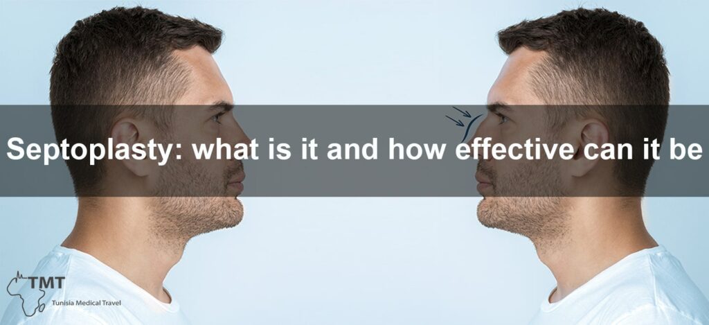 Septoplasty: Procedure, benefits, and recovery