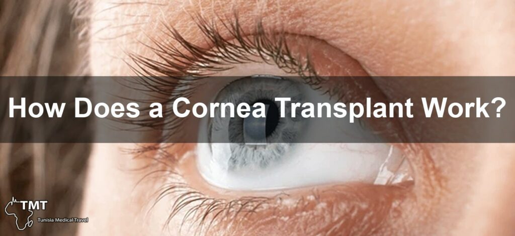 Cornea Transplant: Unveiling surgical marvels and the gift of sight